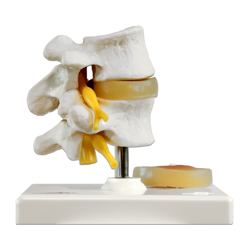 Discos vertebrales lumbares con hernia discal - Columna vertrebral ...